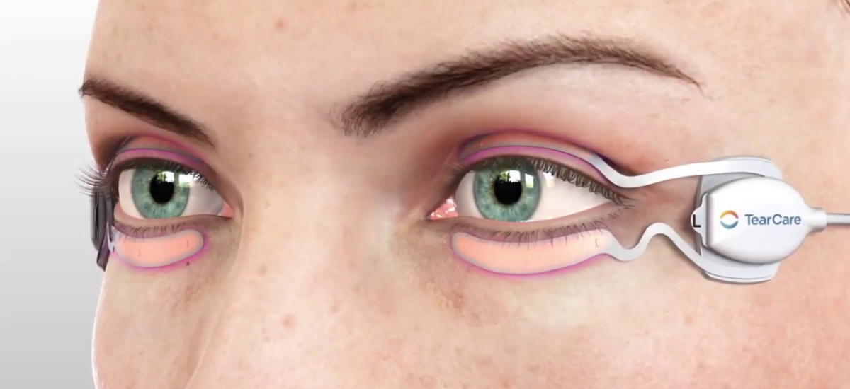 How does TearCare work? sponsored by Trio Eyecare
